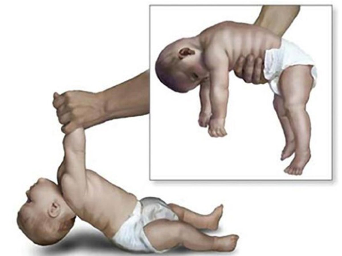 The Role of Less-Common Hyperimmune Globulins