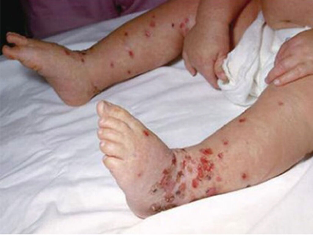 The Role of Less-Common Hyperimmune Globulins