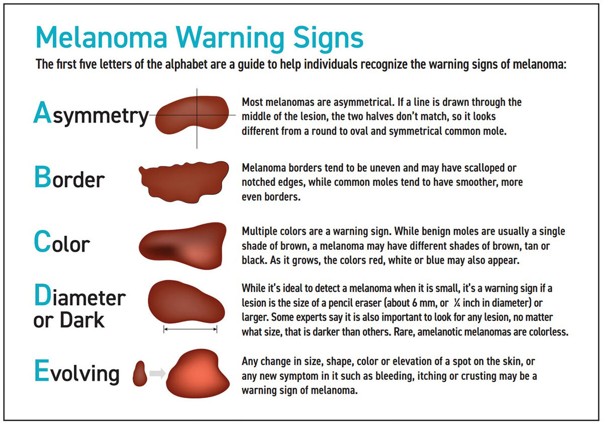 Myths & Facts: Melanoma