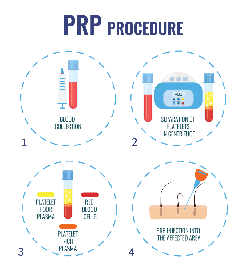 Platelet-Rich Plasma Therapy: The Future of Healing?