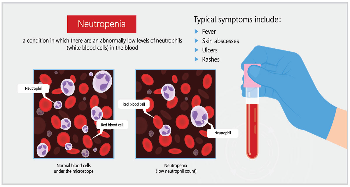 Update on Treating Neutropenia